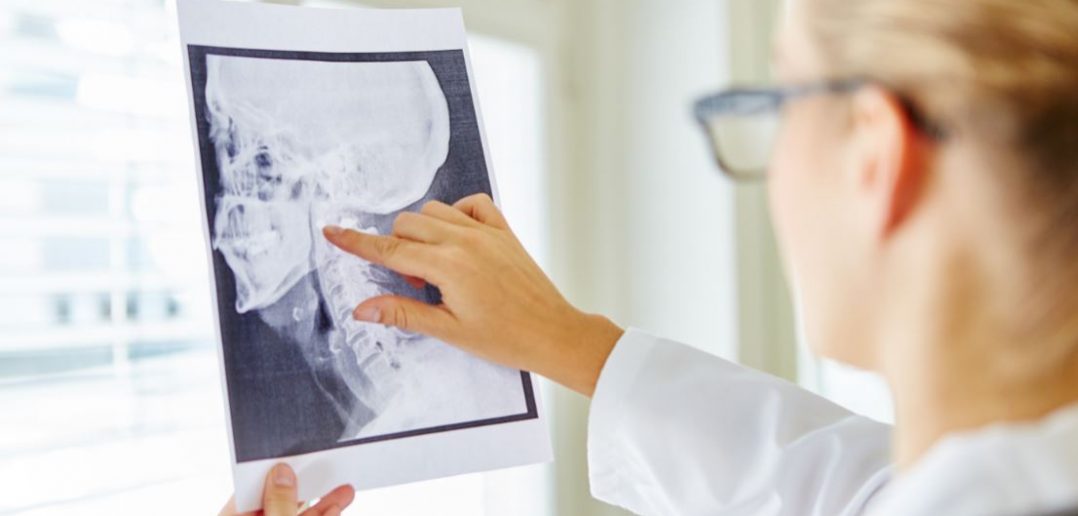 Prognatismo mandibular: causas y consecuencias del ‘mentón prominente’