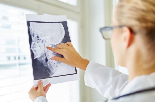 Prognatismo mandibular: causas y consecuencias del ‘mentón prominente’